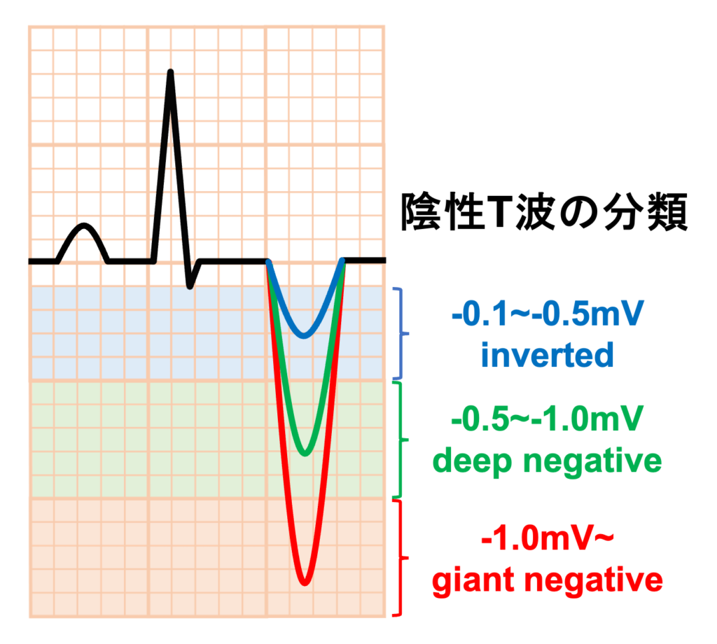 陰性T波とは？ | 心電図.com