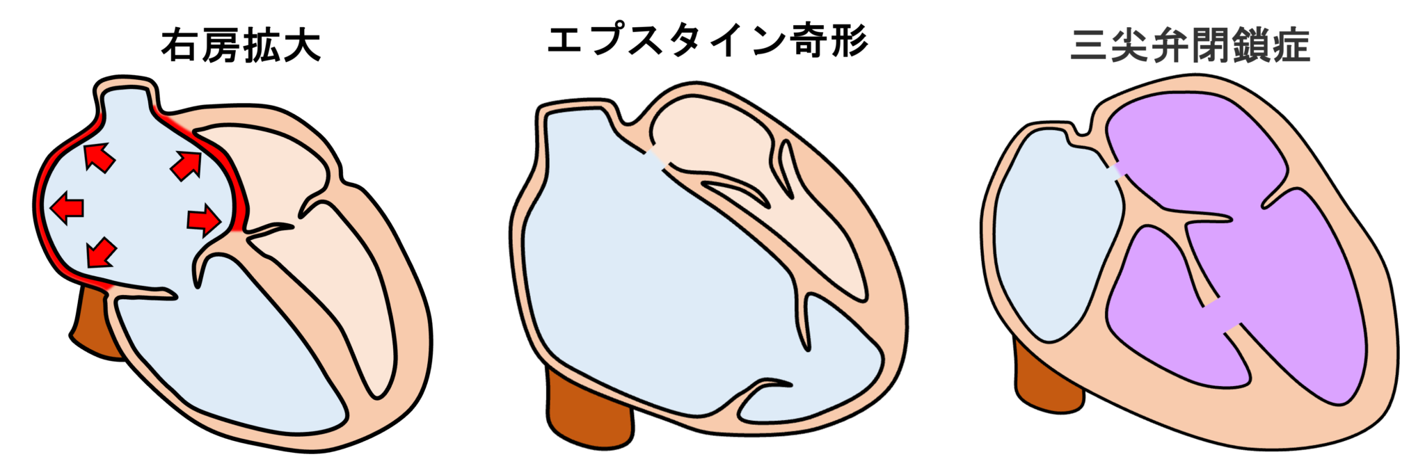 Himalayan P wavesとは？ | 心電図.com