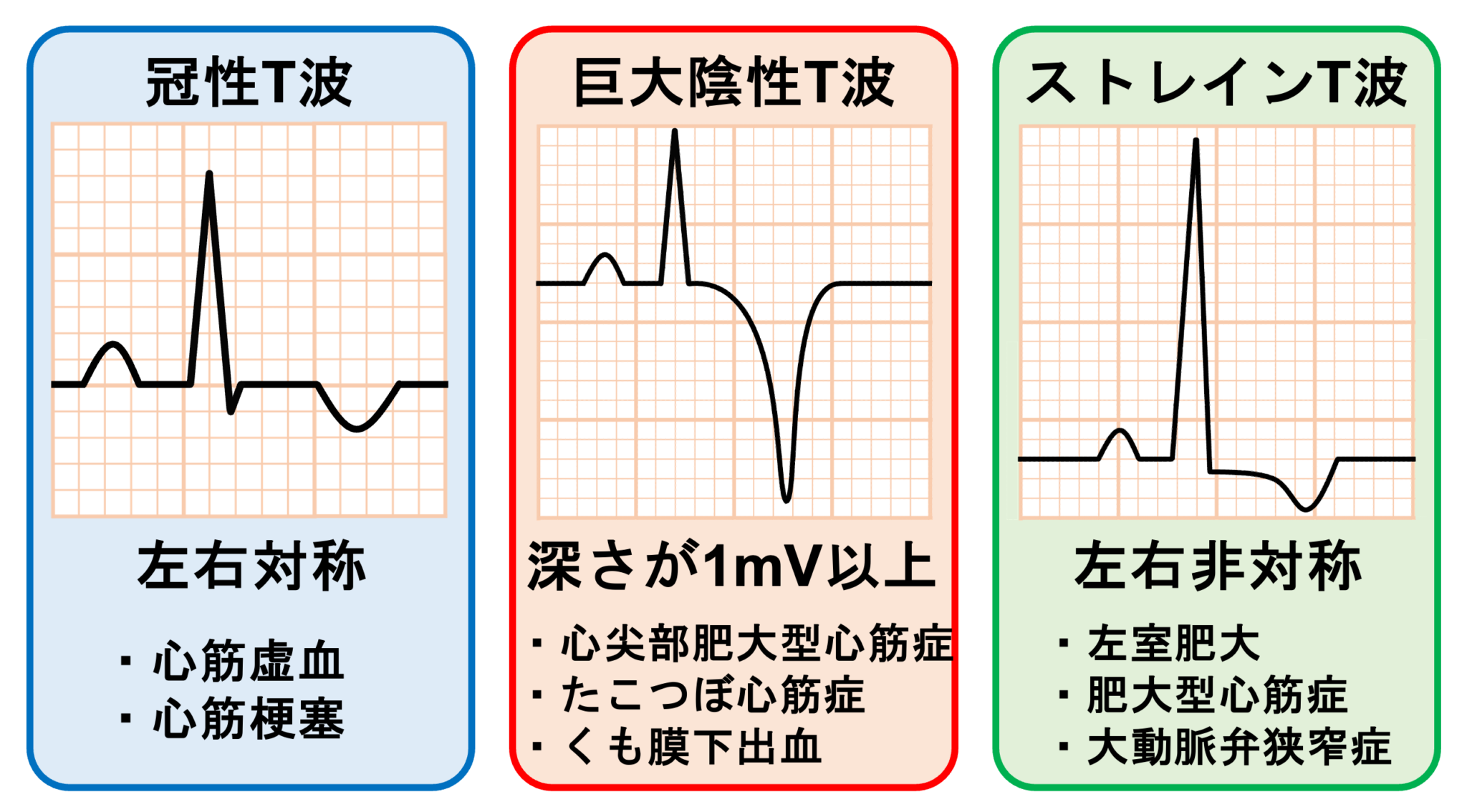 陰性T波とは？ | 心電図.com