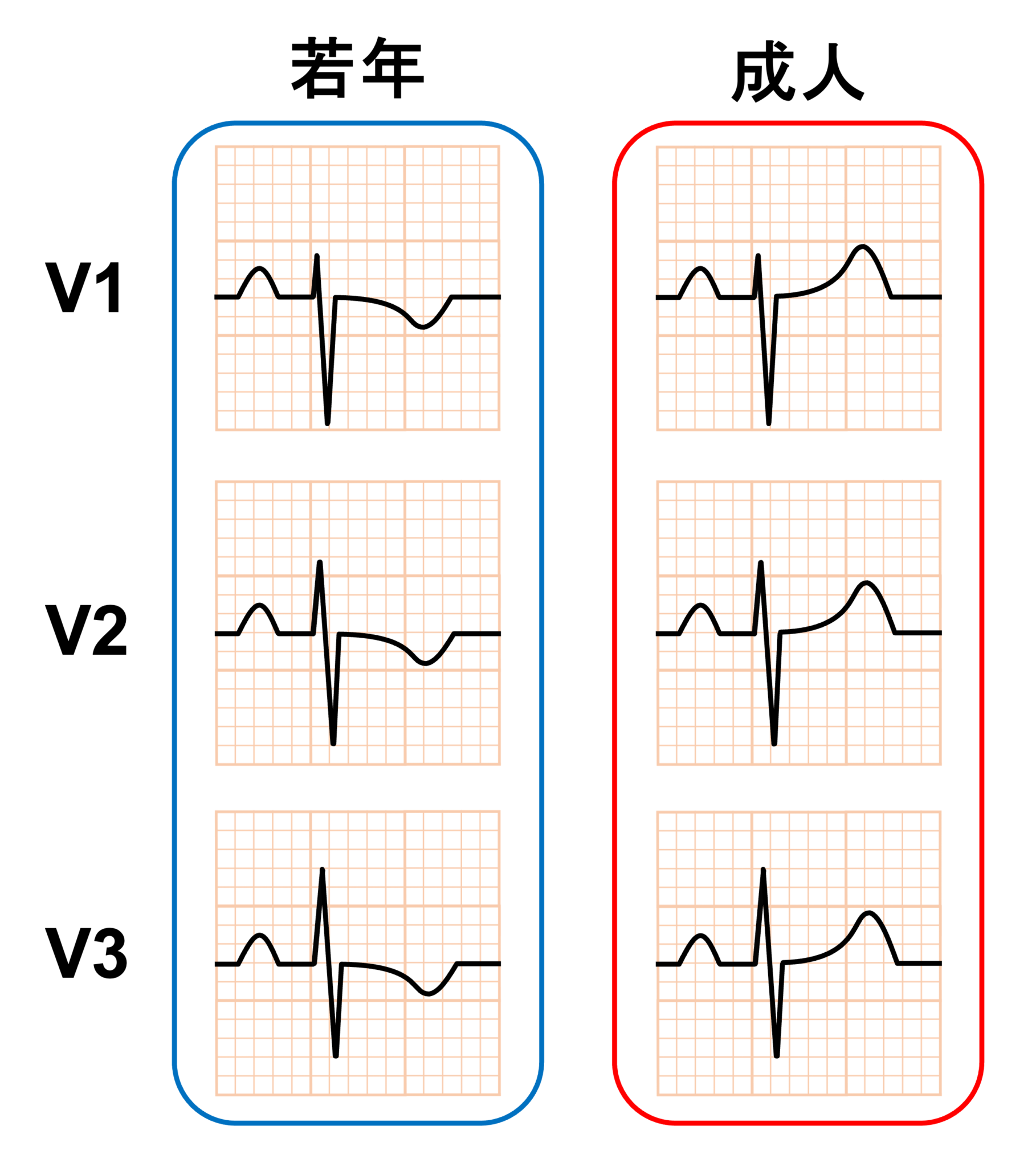 陰性T波とは？ | 心電図.com