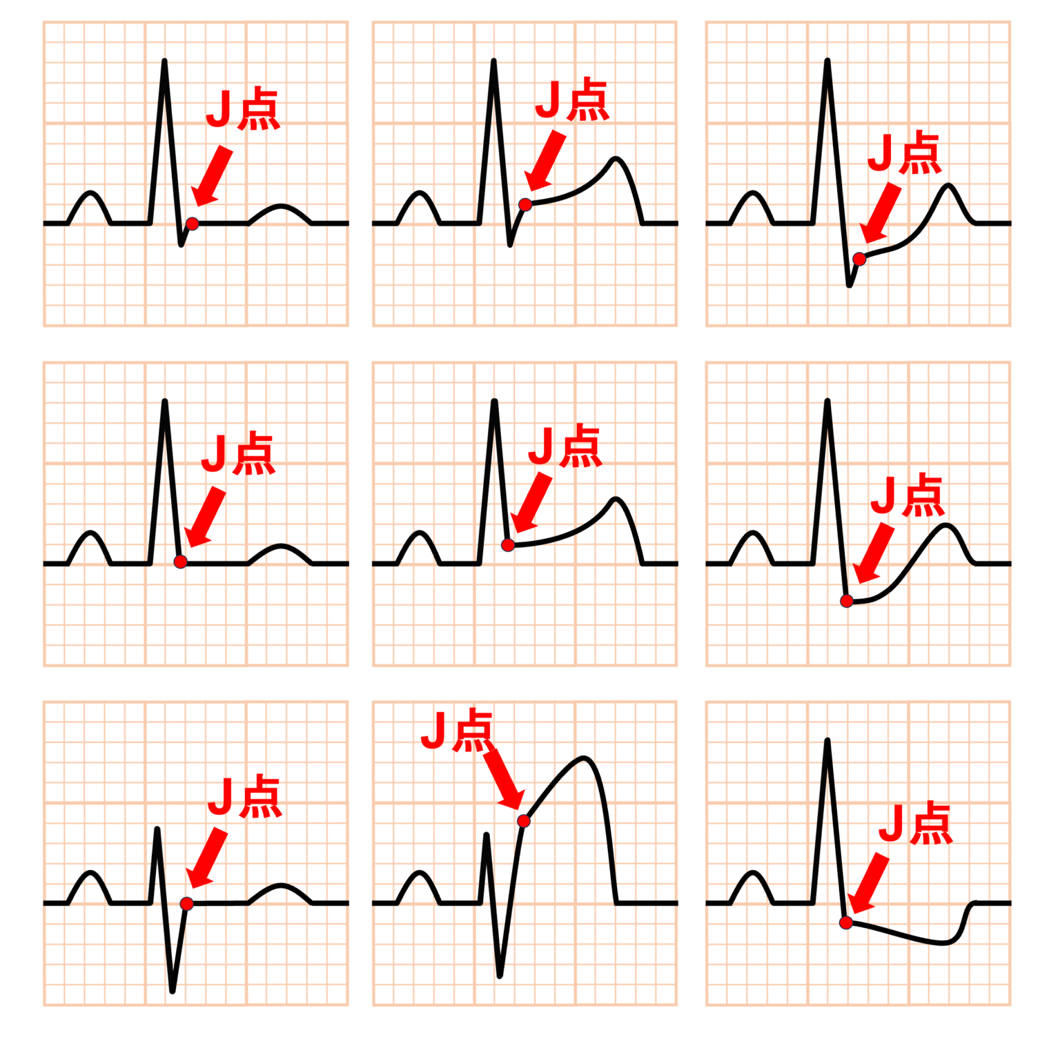 J点とは？ | 心電図.com