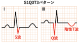 S1Q3T3 patternとは？ | 心電図.com