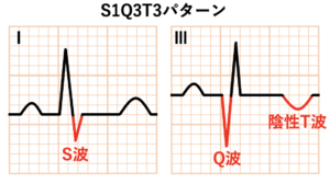 S1Q3T3 patternとは？ | 心電図.com