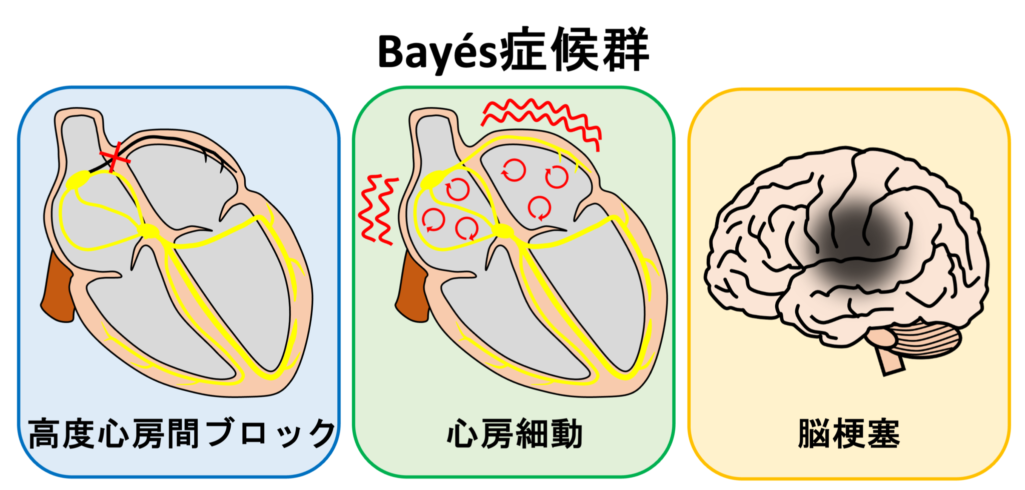 Bayés症候群とは？ | 心電図.com