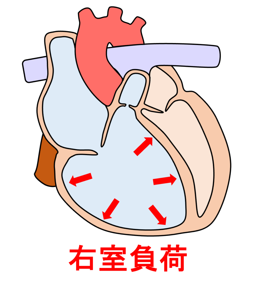 S1Q3T3 patternとは？ | 心電図.com