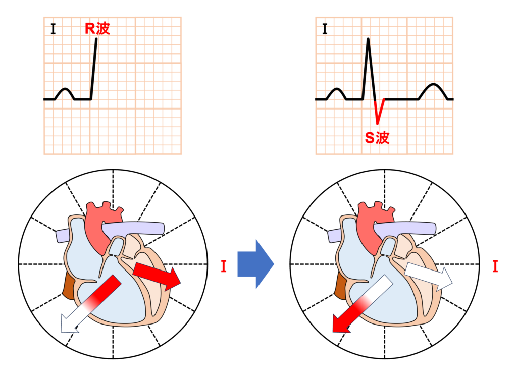 S1Q3T3 patternとは？ | 心電図.com