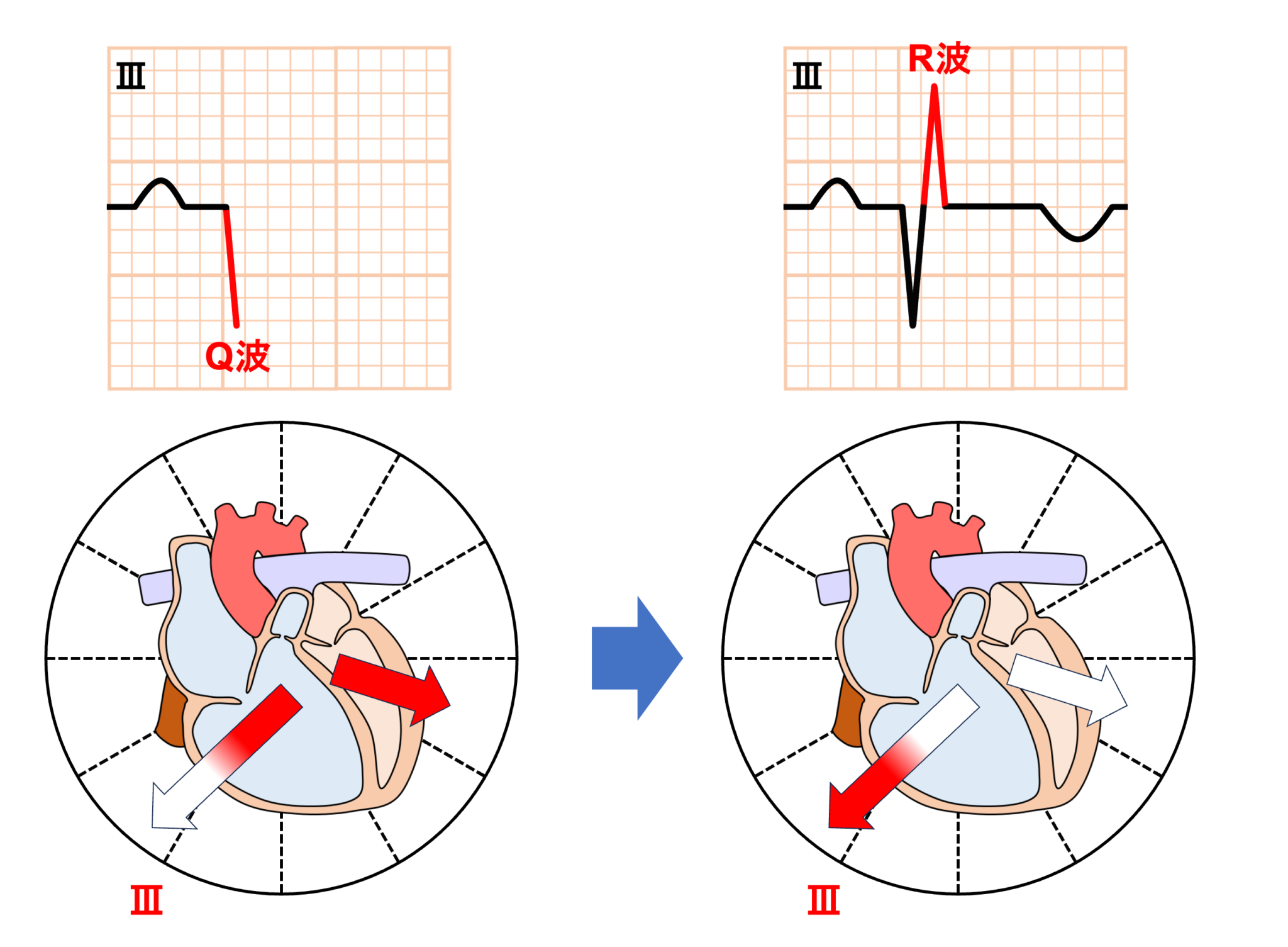 S1Q3T3 patternとは？ | 心電図.com