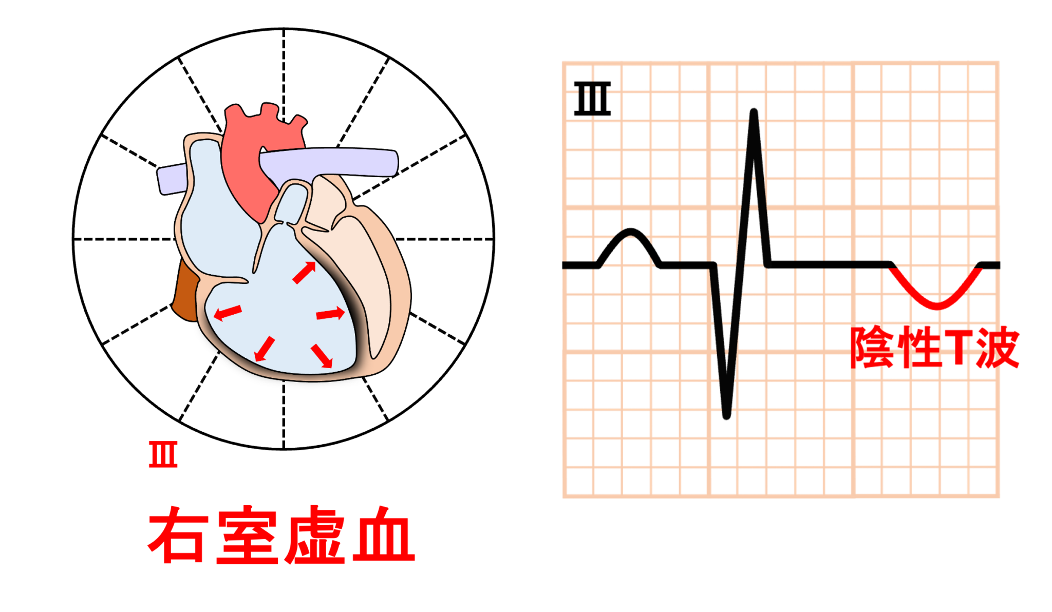 S1Q3T3 patternとは？ | 心電図.com