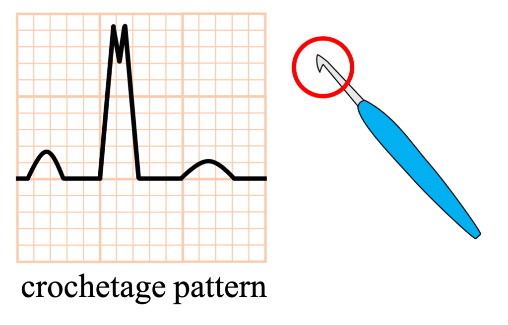 心房中隔欠損症とは? | 心電図.com