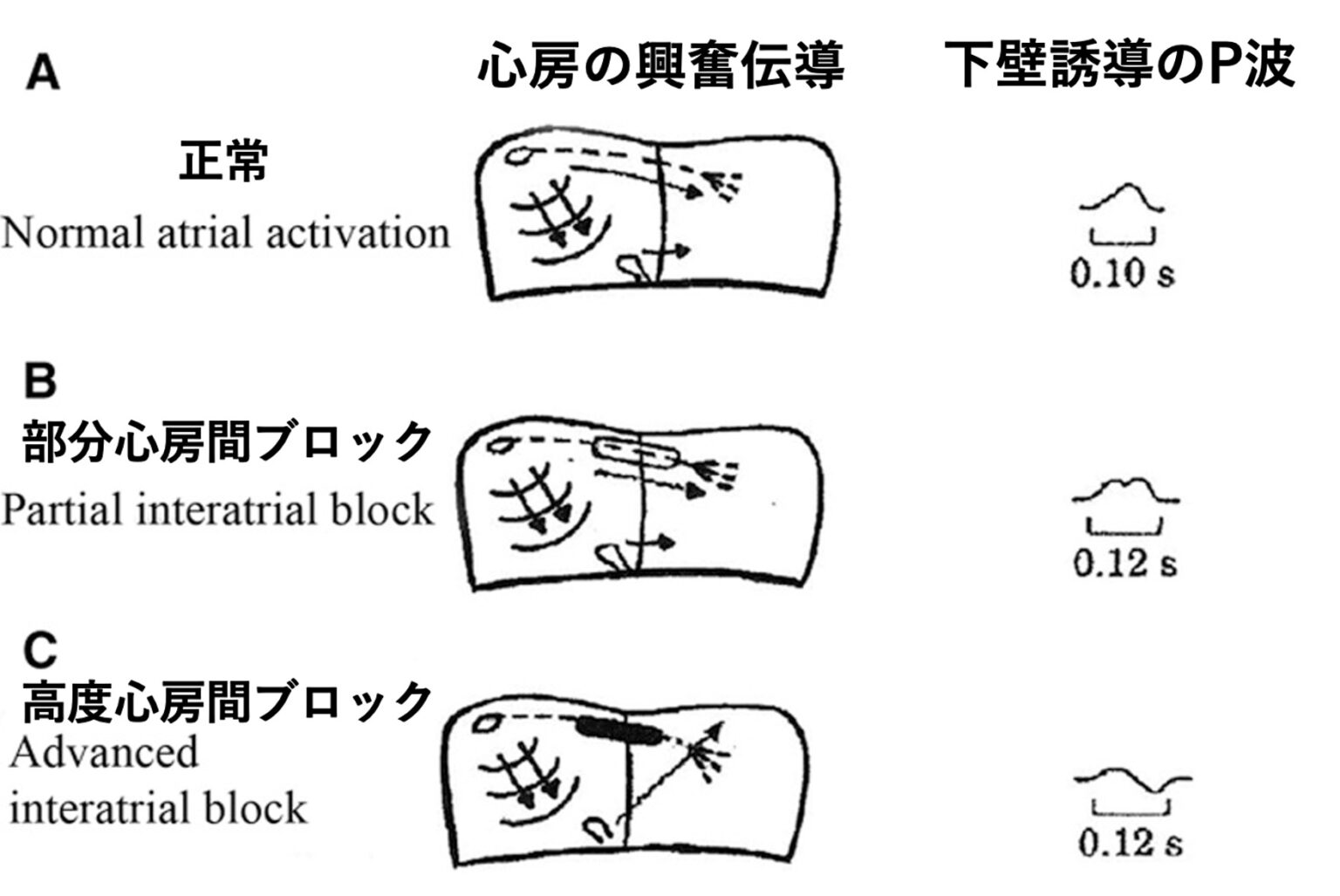 Bayés症候群とは？ | 心電図.com