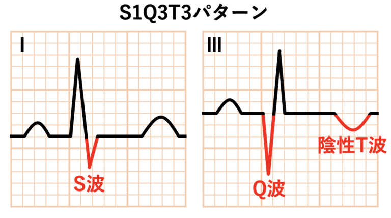 S1Q3T3 patternとは？ | 心電図.com