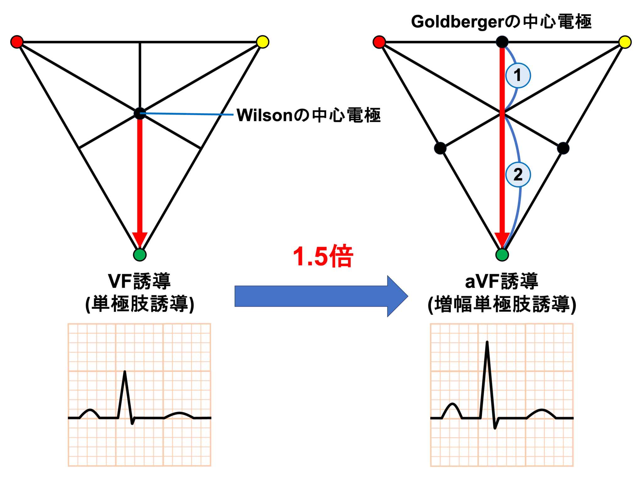 増幅単極肢誘導とは？ | 心電図.com