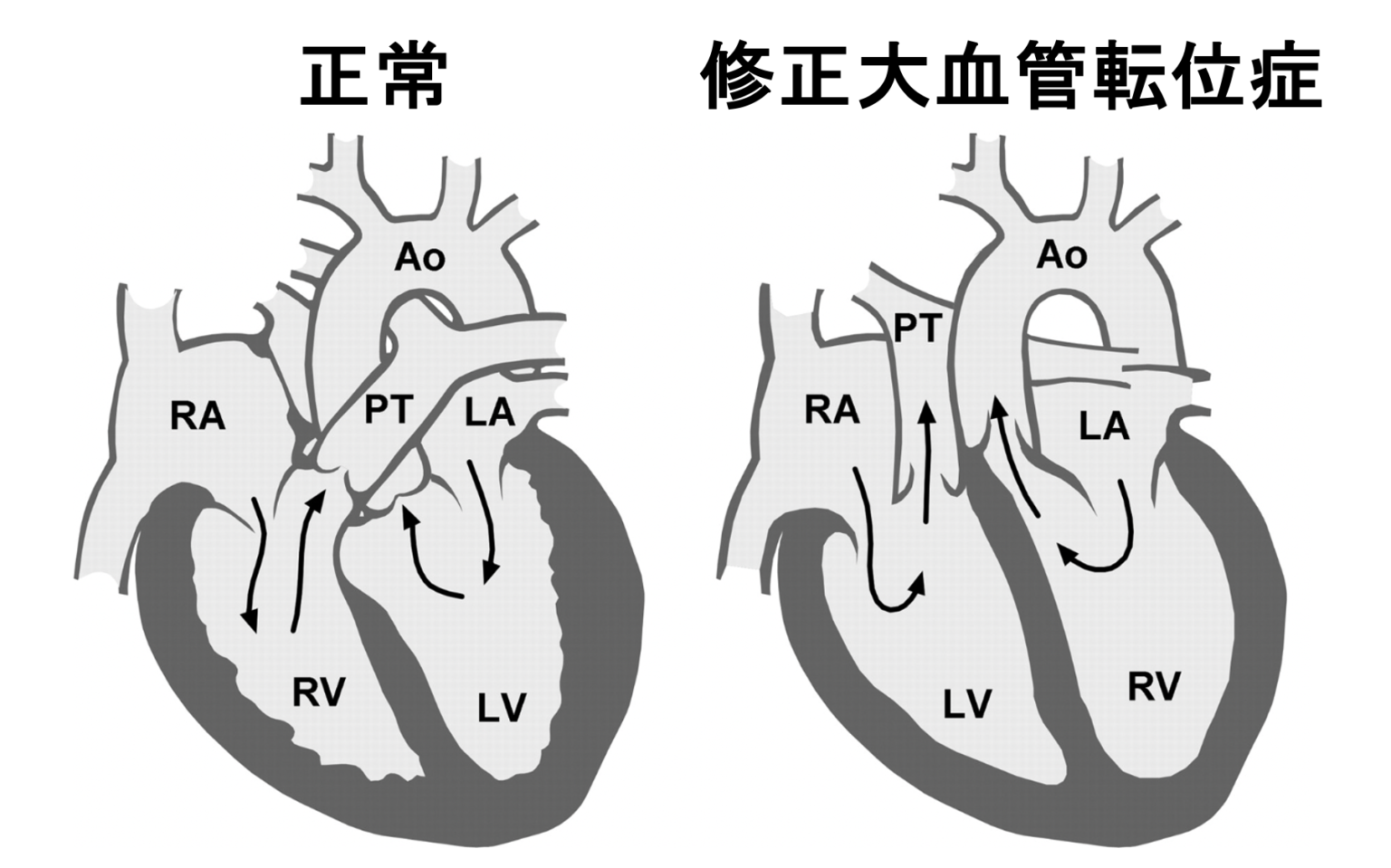 修正大血管転位症とは？ | 心電図.com