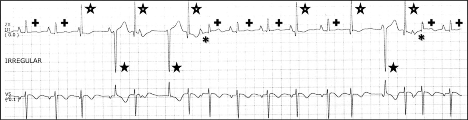 double ventricular parasystoleとは？ | 心電図.com