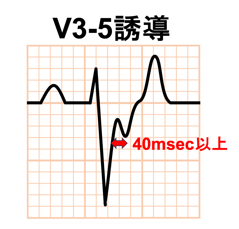 Cabrera’s Signとは？ | 心電図.com