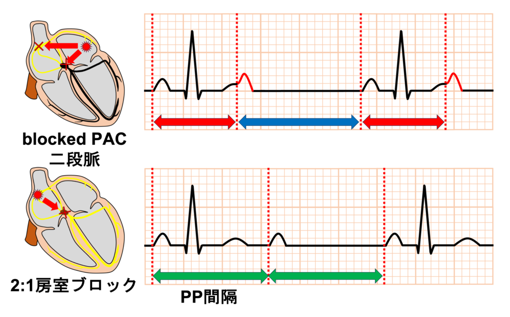 非伝導性心房期外収縮とは? | 心電図.com