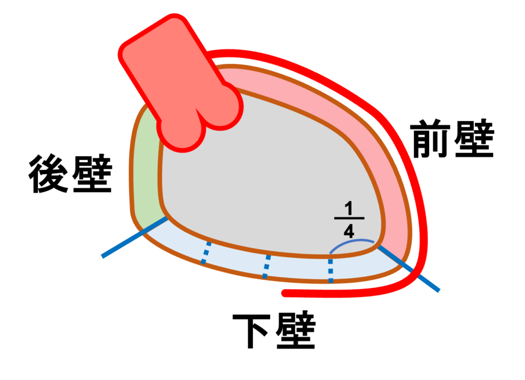 wrapped LADとは？ | 心電図.com