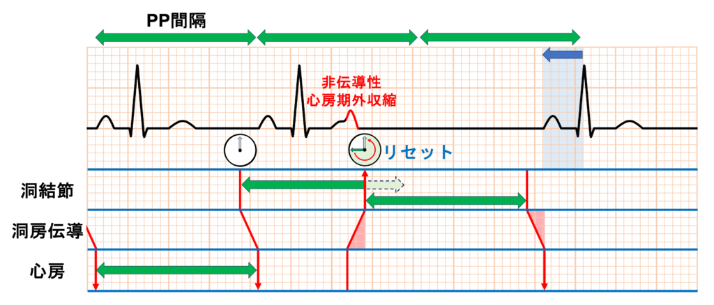 非伝導性心房期外収縮とは? | 心電図.com