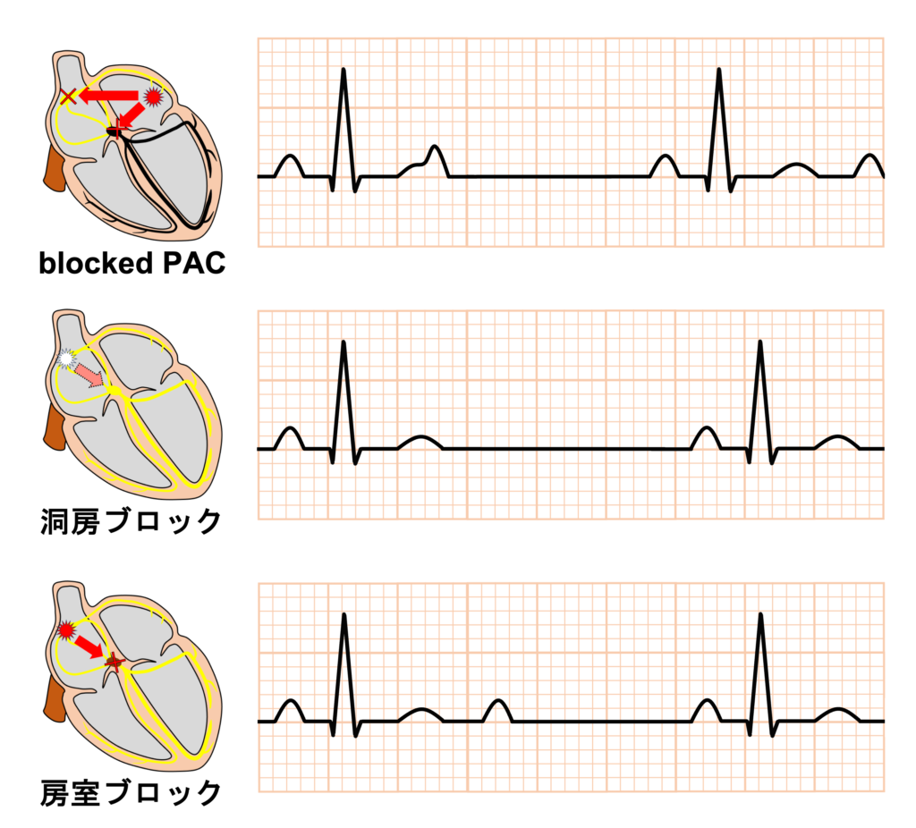 非伝導性心房期外収縮とは? | 心電図.com