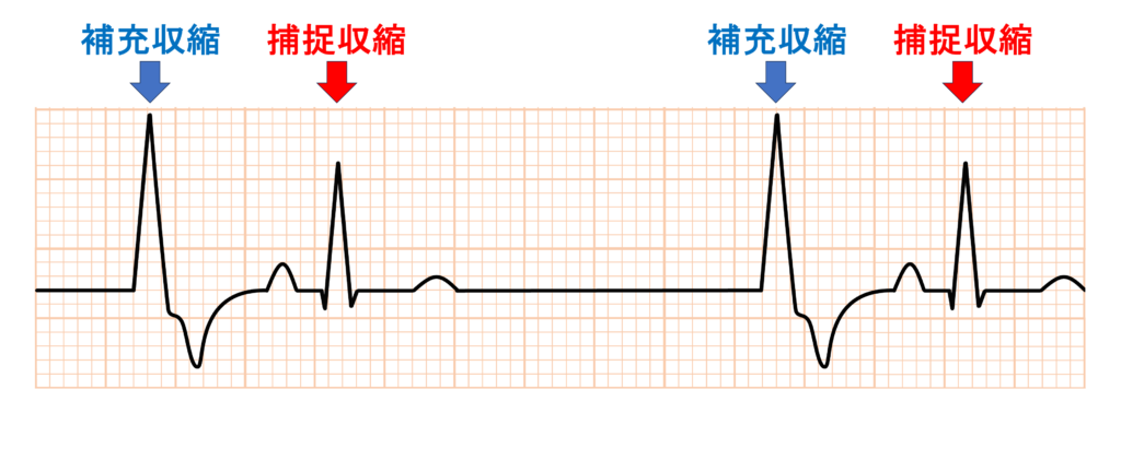 補充捕捉性二段脈とは？ | 心電図.com