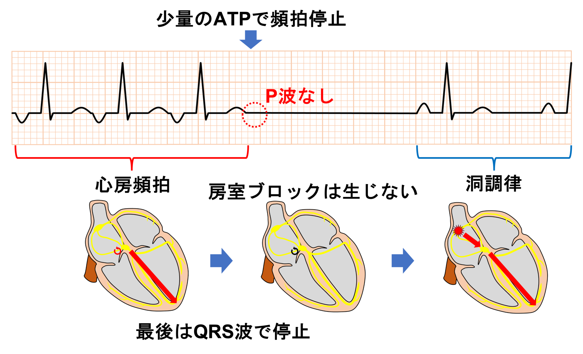 ATP感受性心房頻拍とは？ | 心電図.com
