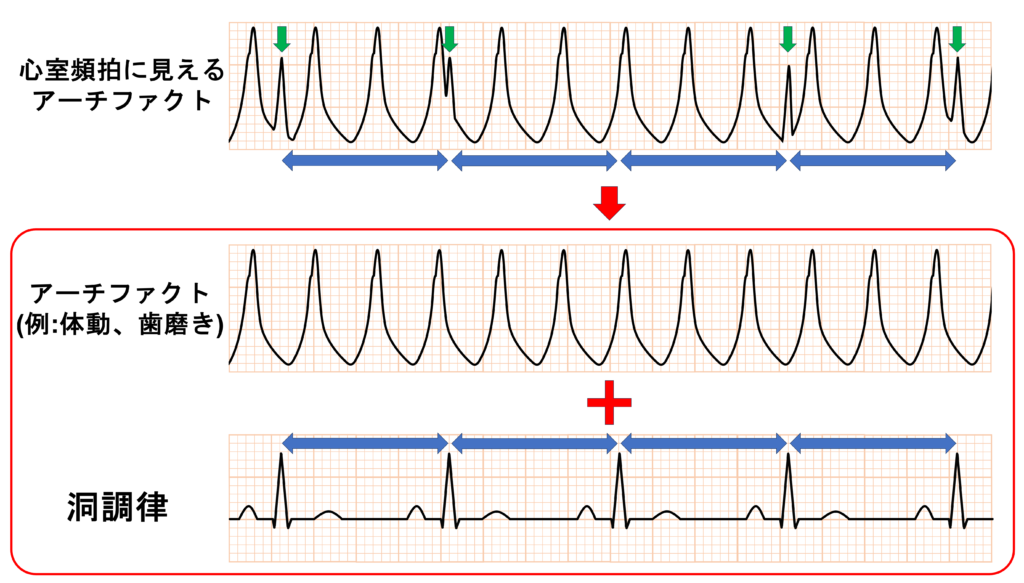 notch signとは？ | 心電図.com