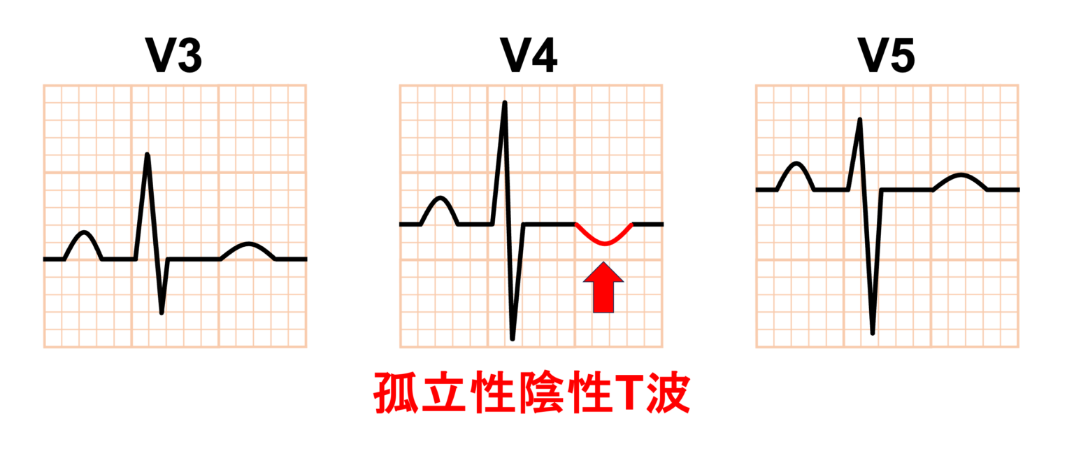 心房中隔欠損症とは? | 心電図.com