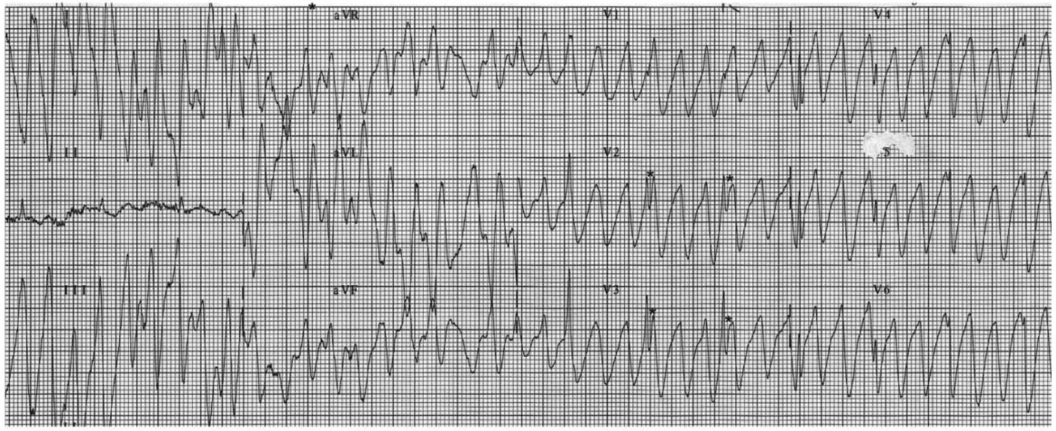 notch signとは？ | 心電図.com