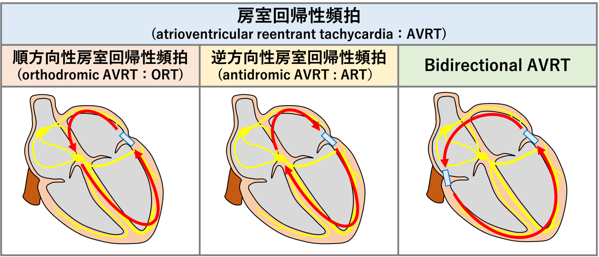 房室回帰性頻拍(AVRT)とは？ | 心電図.com